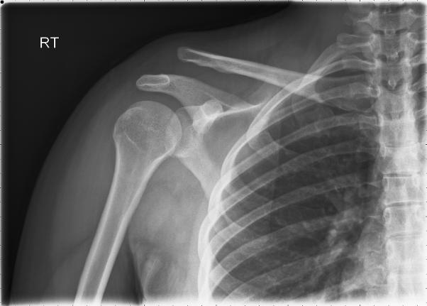 Shoulder Separations | Dr. David Geier - Sports Medicine Simplified