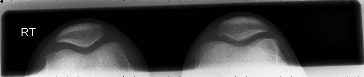 Is running bad for your knees? | Dr. David Geier - Sports Medicine ...