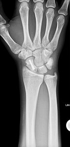 What Does Scaphoid Abdomen Indicate