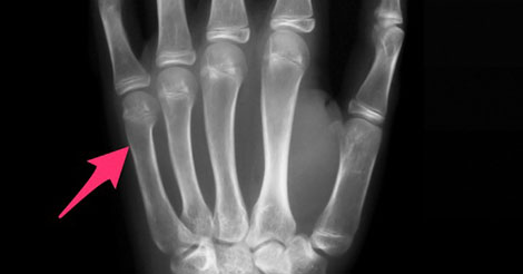 When should you see a doctor for a boxer’s fracture? | Dr. David Geier ...